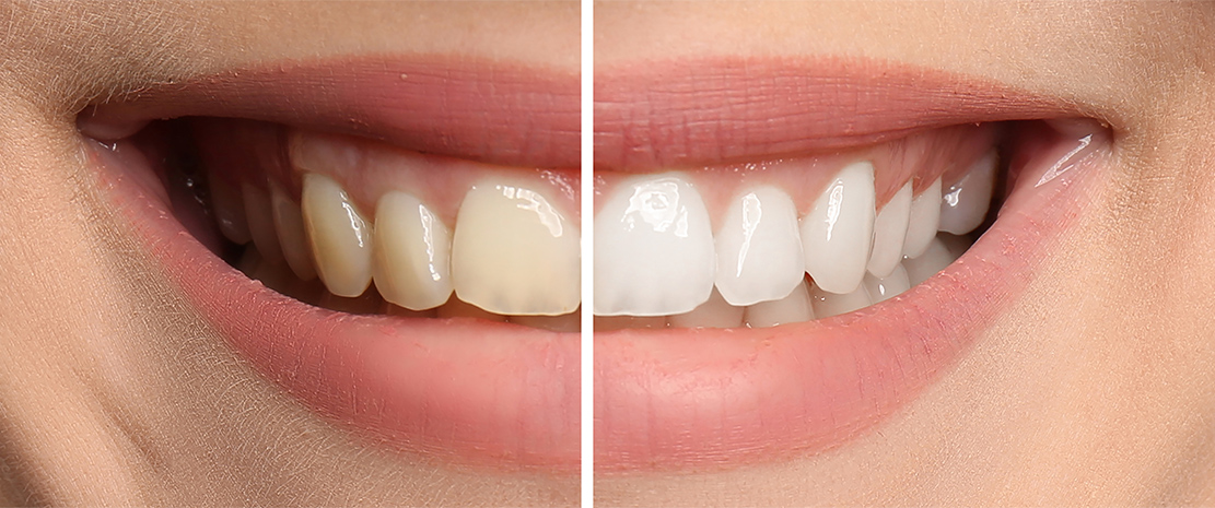 What Causes Teeth Stains (& How Do You Get Rid of Them)? - Artis Dental ...