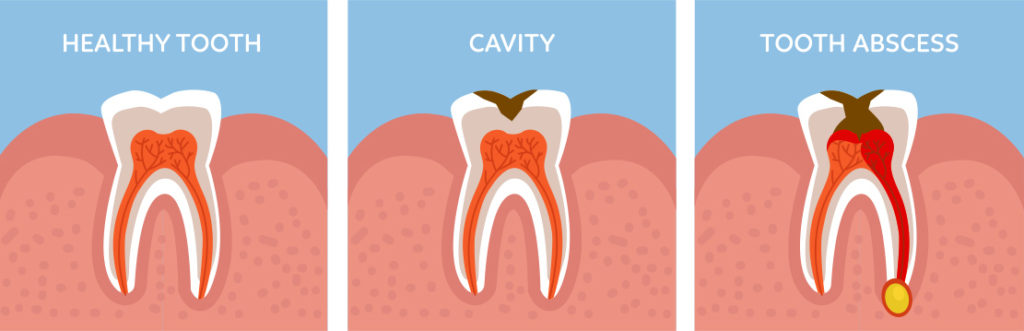 What Are the Most Common Causes of Toothaches?