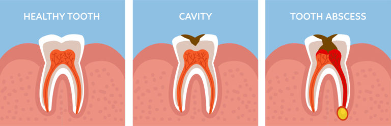 What Are the Most Common Causes of Toothaches?